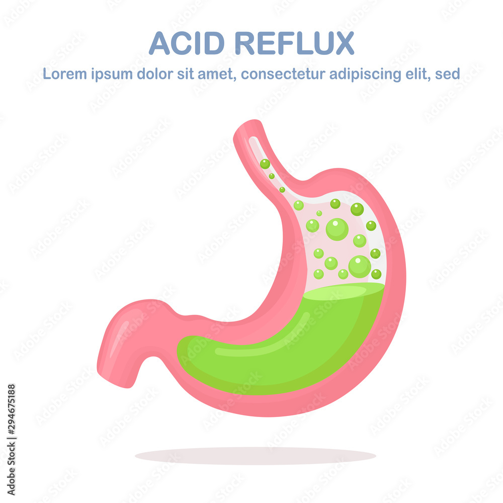 Human stomach. Gastroesophageal reflux disease. GERD, heartburn ...