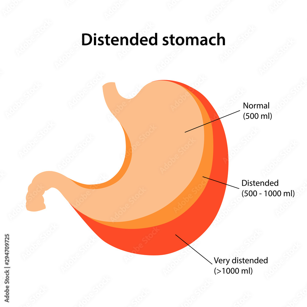 Distended stomach. Stages of distension of the stomach. Flat vector ...