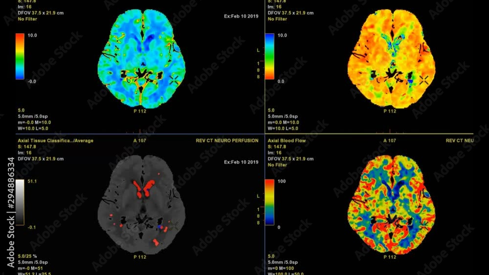CT Brain Perfusion or CT scan image of the brain 3d rendering image ...