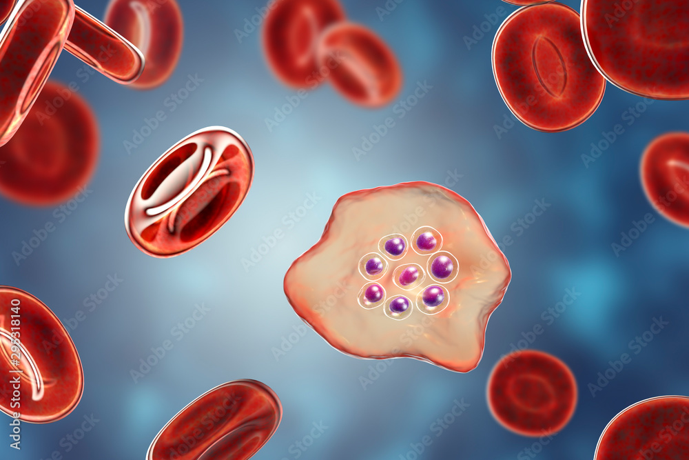 The malaria-infected red blood cells. 3D illustration showing malaria ...