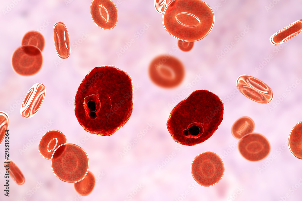 The malaria-infected red blood cells. 3D illustration showing malaria ...