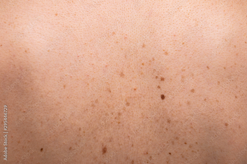 Pigmentation spots and birthmarks on skin close up Stock Photo | Adobe ...