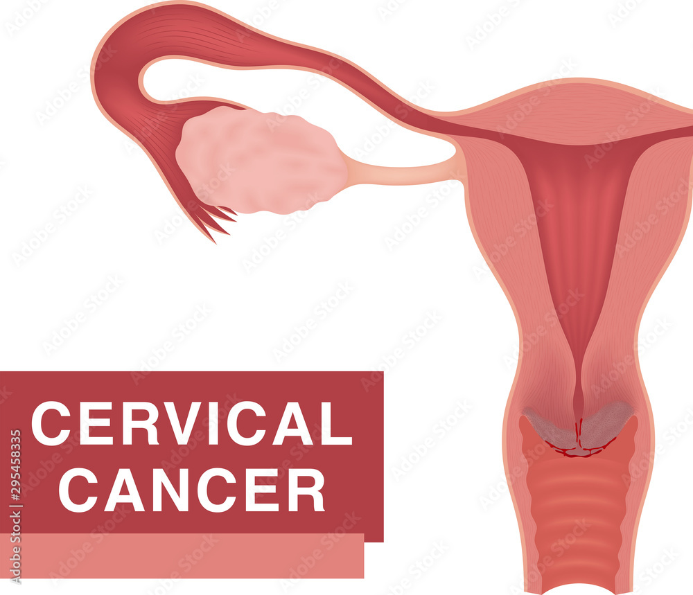 Cervical Cancer Vector Medical Illustration With Inscriptions Sick