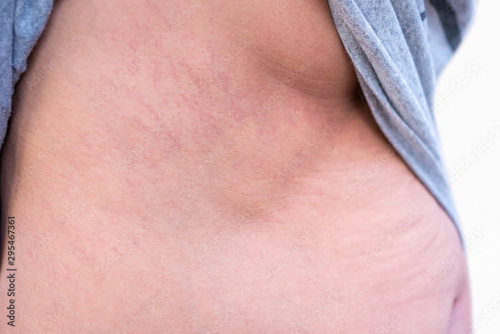 Hepatic cirrhosis /Spider nevi pathophysiology of patients who drink ...