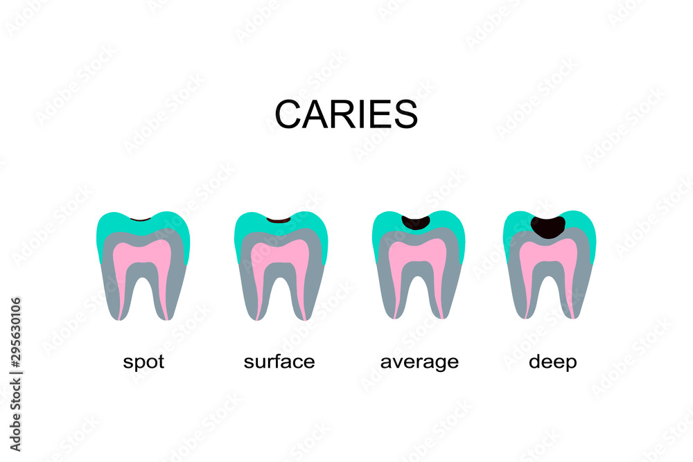 Caries classification spor surface average deep cavity hand drawn ...