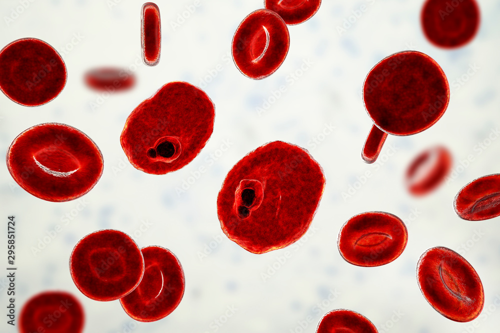 The malaria-infected red blood cells. 3D illustration showing malaria ...