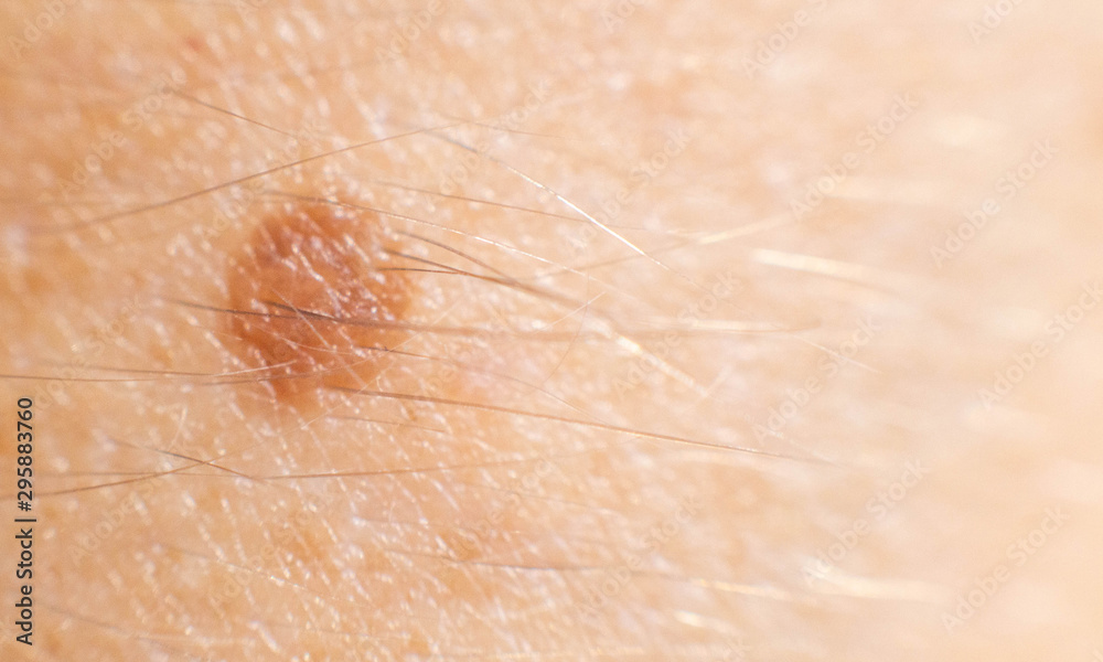 Small mole nevus on human skin, carcinoma. Background, macro Stock ...