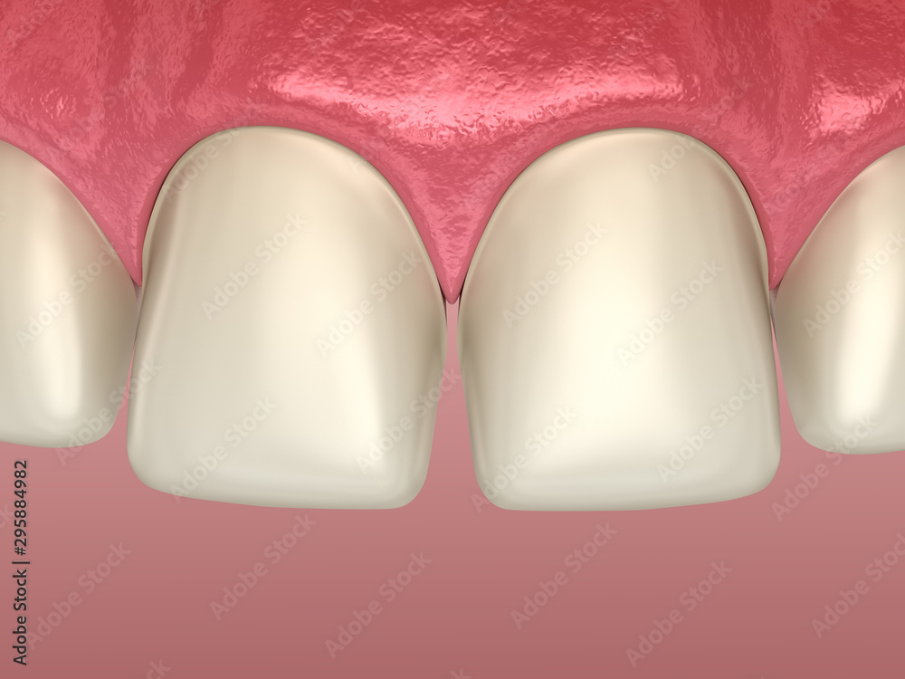 Teeth preparation for Veneer installation procedure over central ...