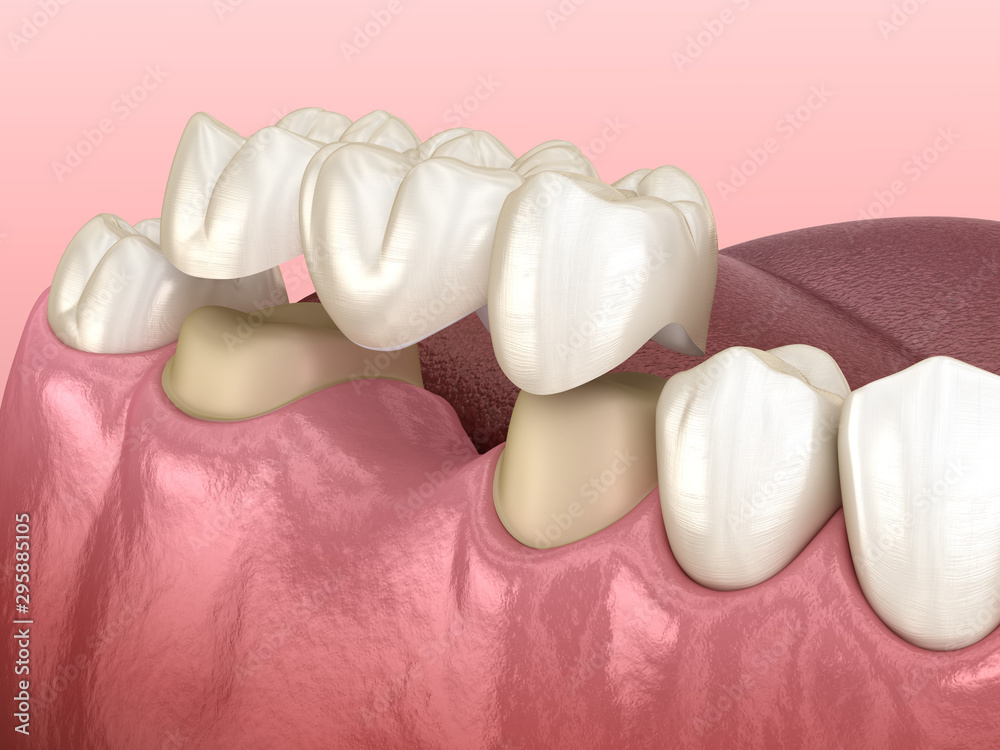 Dental bridge of 3 teeth over molar and premolar. Medically accurate 3D ...