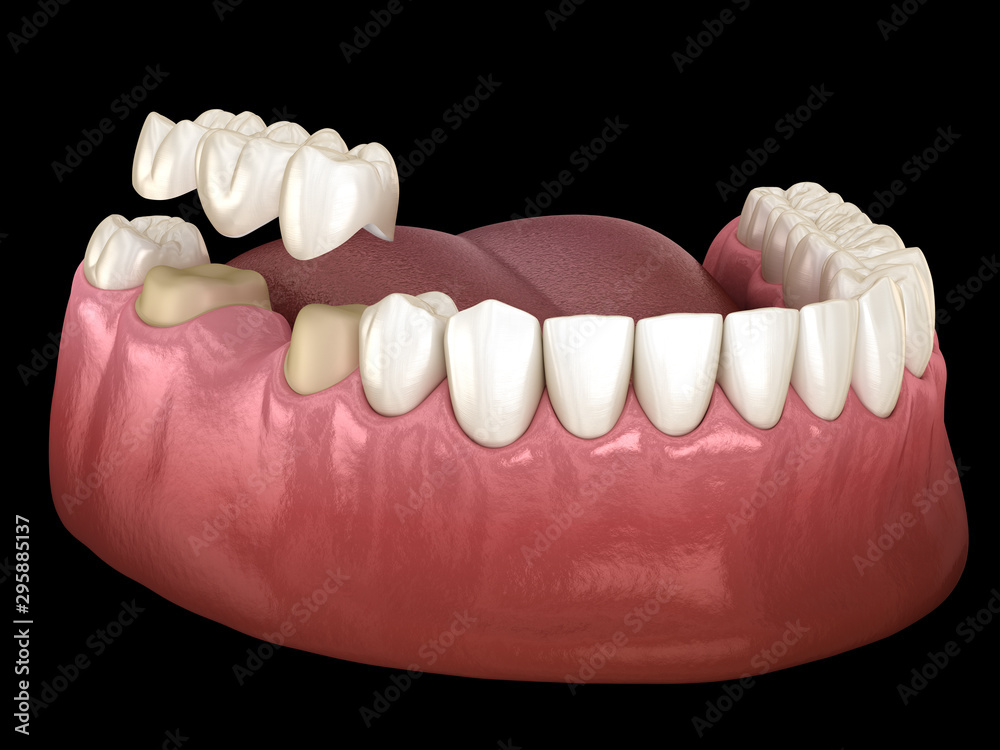 Dental bridge of 3 teeth over molar and premolar. Medically accurate 3D ...