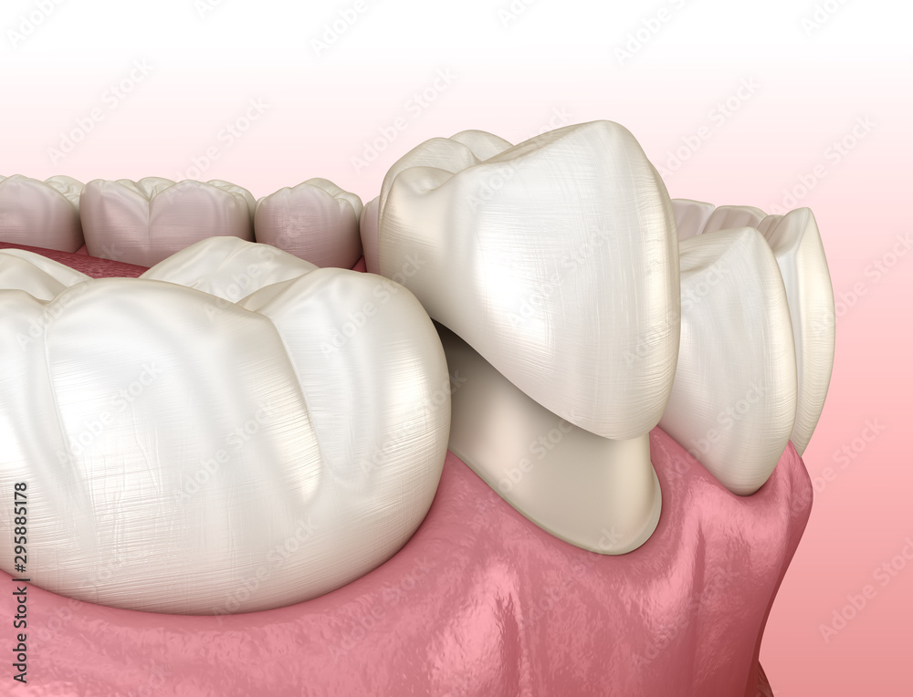 Preparated premolar tooth for dental crown placement. Medically ...