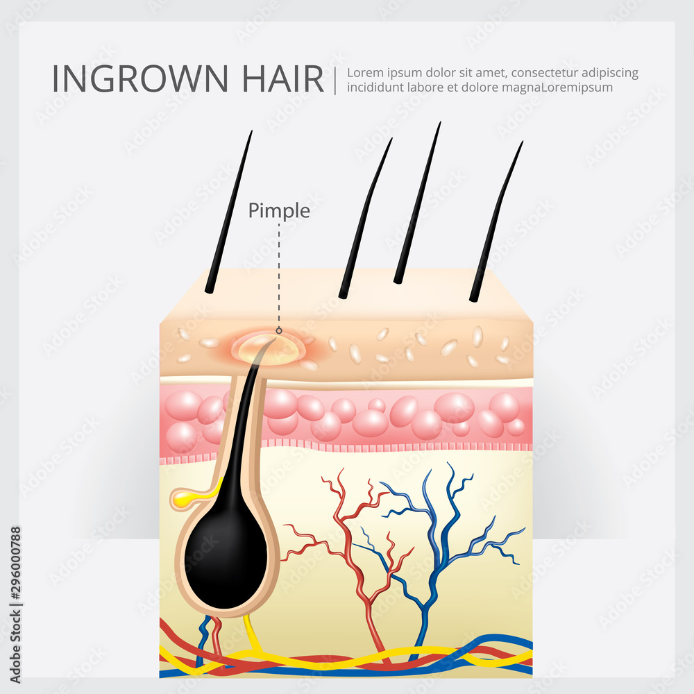 Vetor de Ingrown Hair Structure Vector Illustration do Stock | Adobe Stock