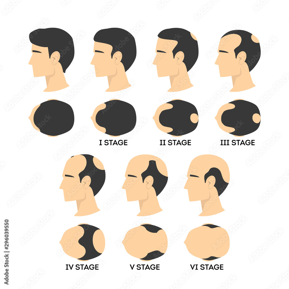 Alopecia stages set. Hair loss, balding process. Male Stock Vector ...