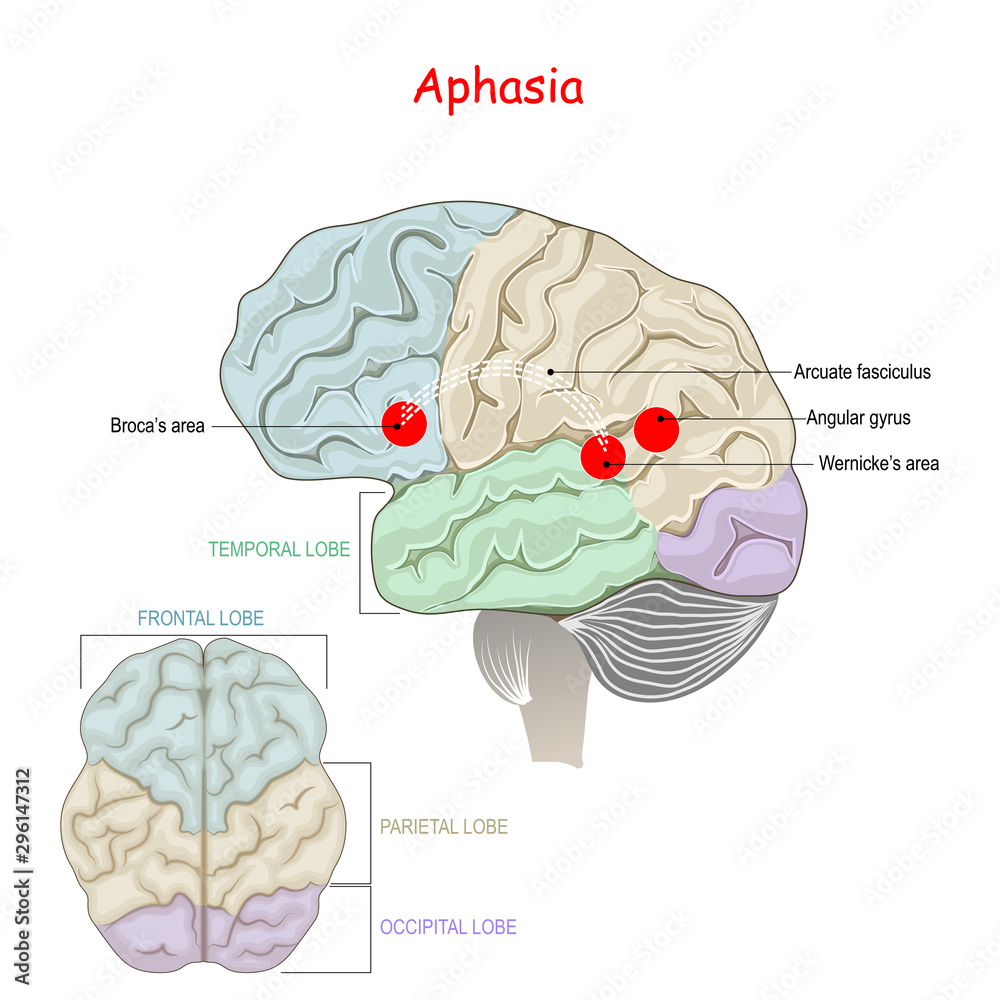 Aphasia. Human Brain with damage to specific areas. Stock Vector ...