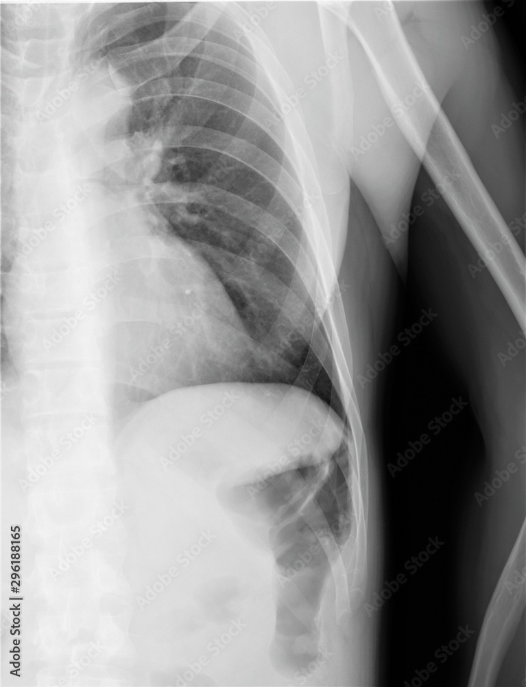 x-ray of the left half of the chest, rib bones Stock Photo | Adobe Stock