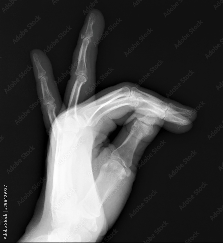 on the x-ray fracture of the nail phalanx 3 fingers of the hand ...