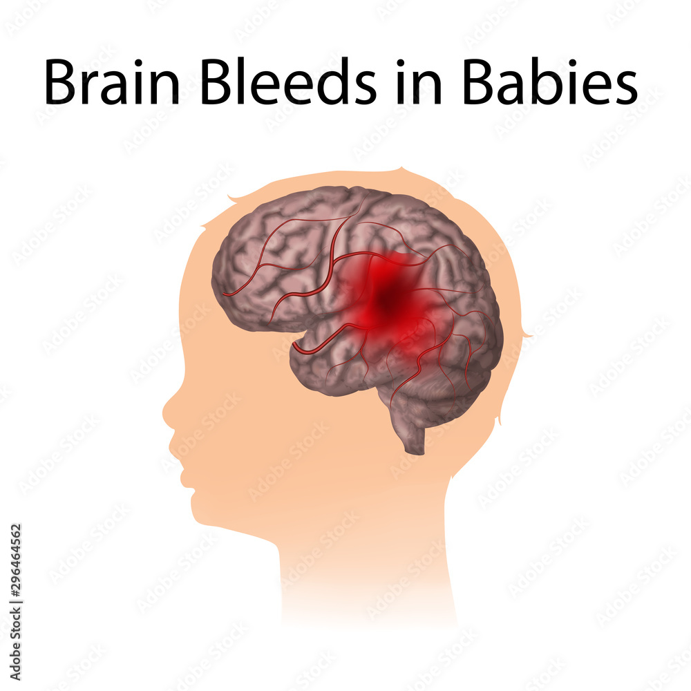 Brain bleeds in babies. Hemorrhage. Blood, head. Medical illustration ...