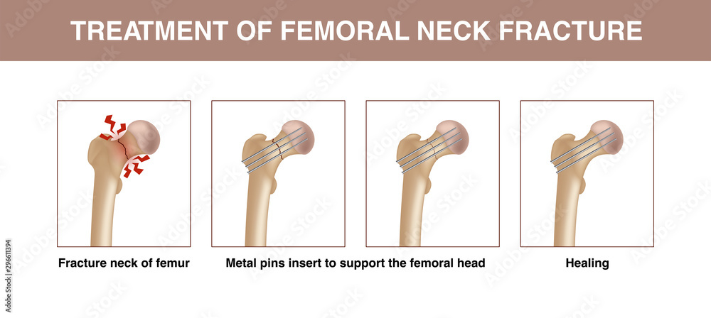 Vecteur Stock Treatment Of Femoral Neck Fracture Vector Illustration