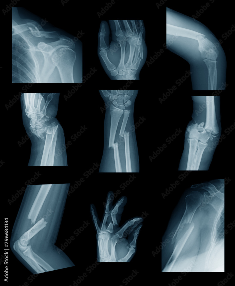 Collection X-ray image showing upper limb or uper extremity fractures ...