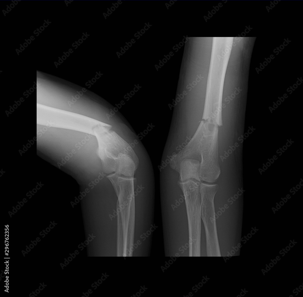 X-ray image of elbow joint, lateral and front views showing lower ...