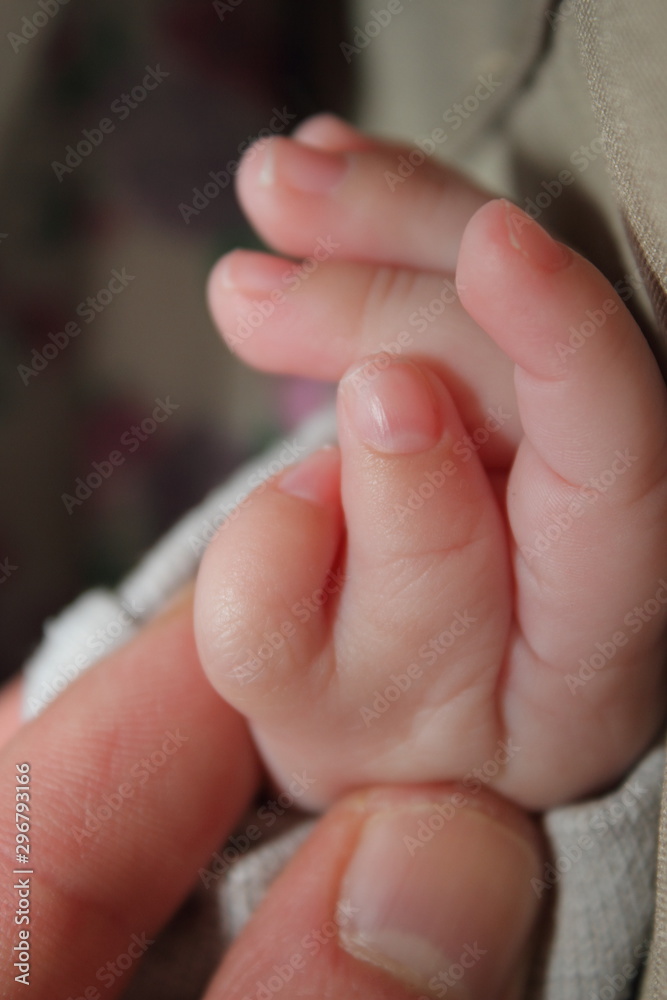 Polydactyly Preaxial, Polydactyly on human; rare abnormal ...