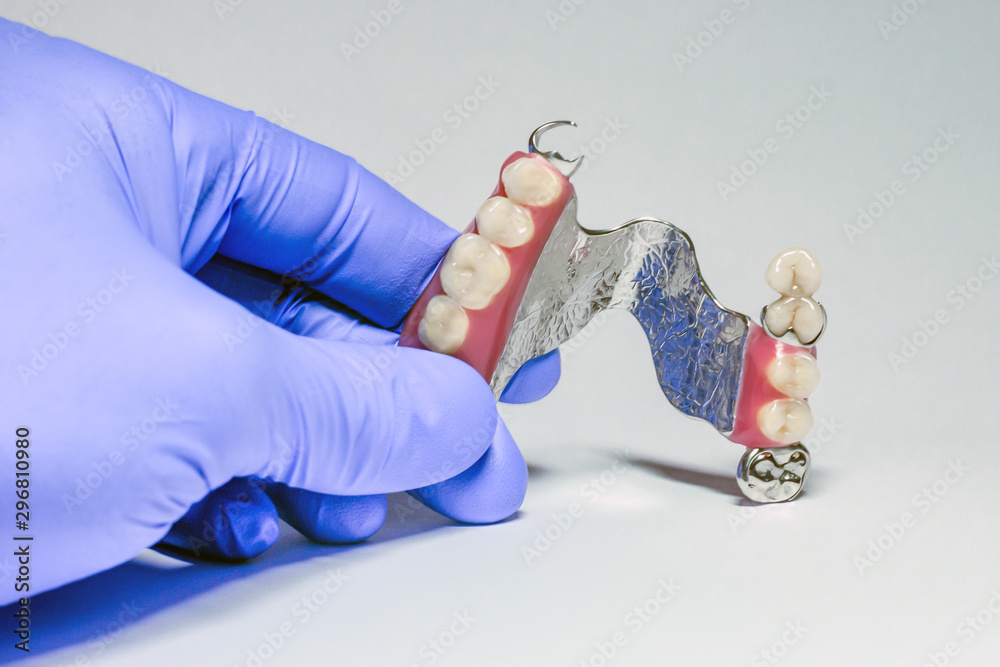 false teeth in the dentist's hand. blue glove. removable clasp ...