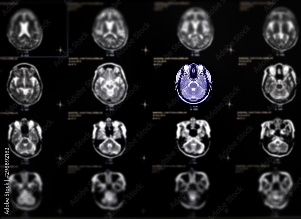 Axial Head Mri Scan