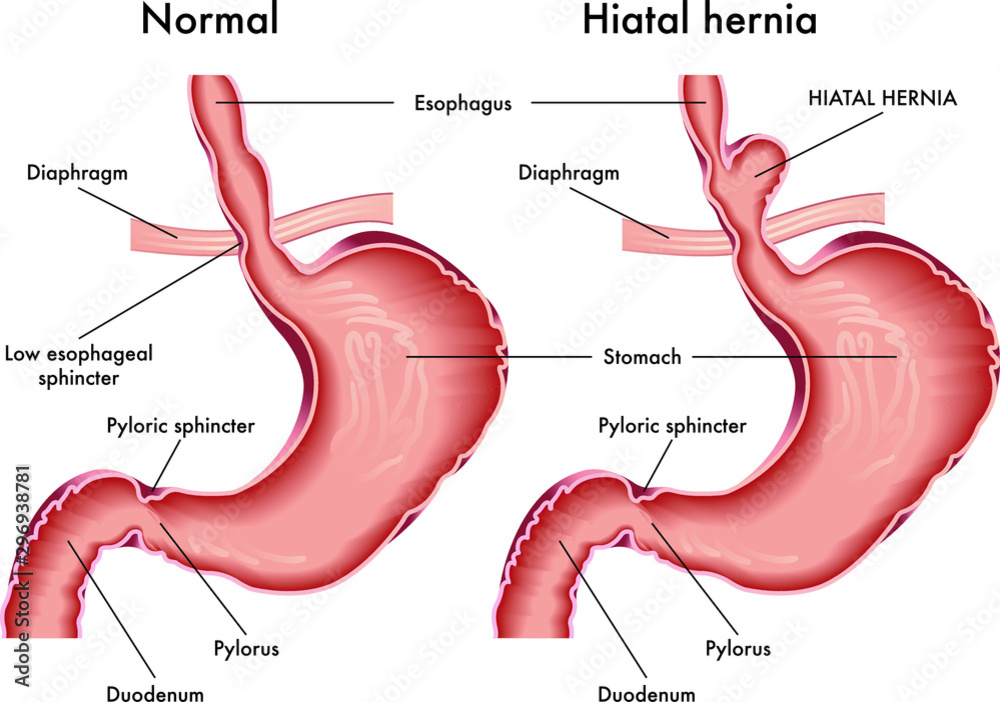 Medical illustration of stomach with hiatal hernia with annotation ...