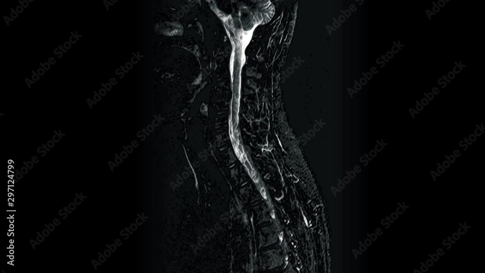 Volumetric MRI of the cervical spine, detection of protrusions and ...