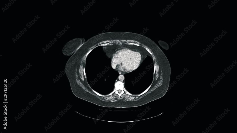 MRI scan of the lungs and bronchi, diagnosis of respiratory diseases ...