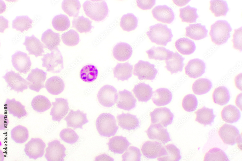 Malaria parasite in red blood cells, ring form stage of Plasmodium ...