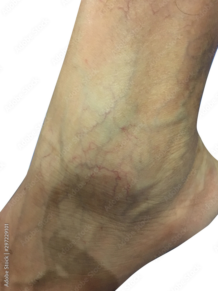 Varicose veins Ankle joint of Lady with background White. Stock Photo ...
