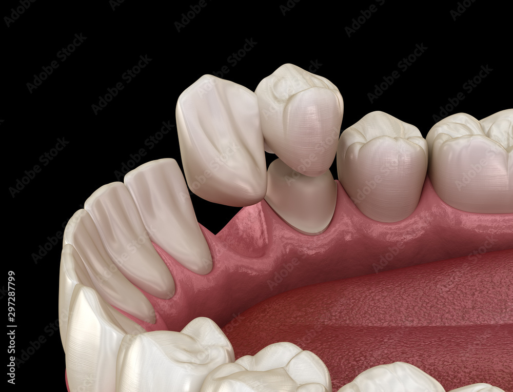 Maryland bridge made from ceramic, frontal tooth recovery. Medically ...