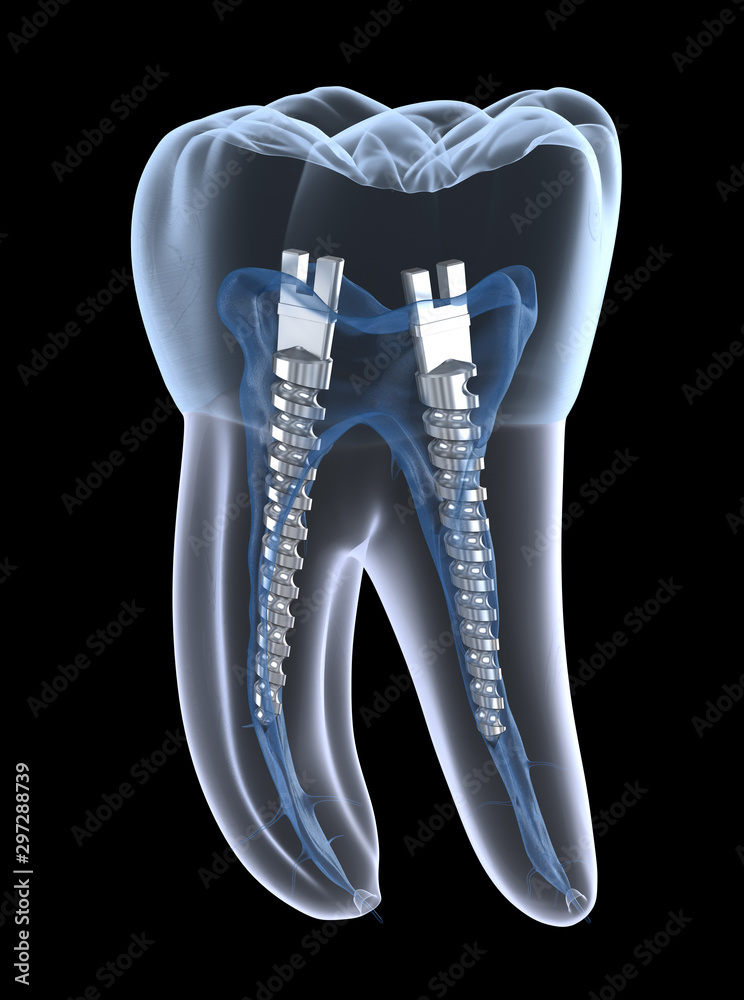Dental steel post inside molar teeth, Xray view. Dental endodontic ...