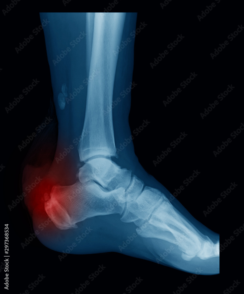 X-ray image of Lateral calcaneus (heel) showing achilles tendon rupture ...