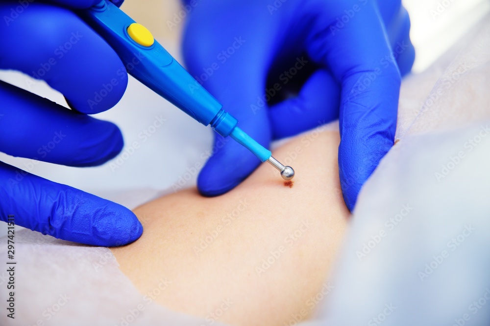 Medical surgical treatment removal of a mole on the hand of a young ...