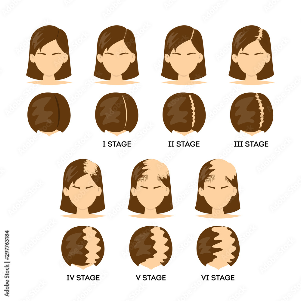 Alopecia stages set. Female balding in process. Stock Vector | Adobe Stock