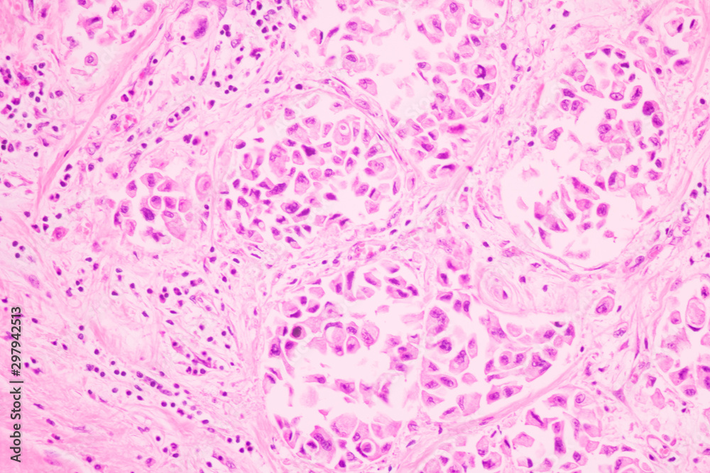 Section tissue of breast cancer view in microscopy.Ductal cell ...