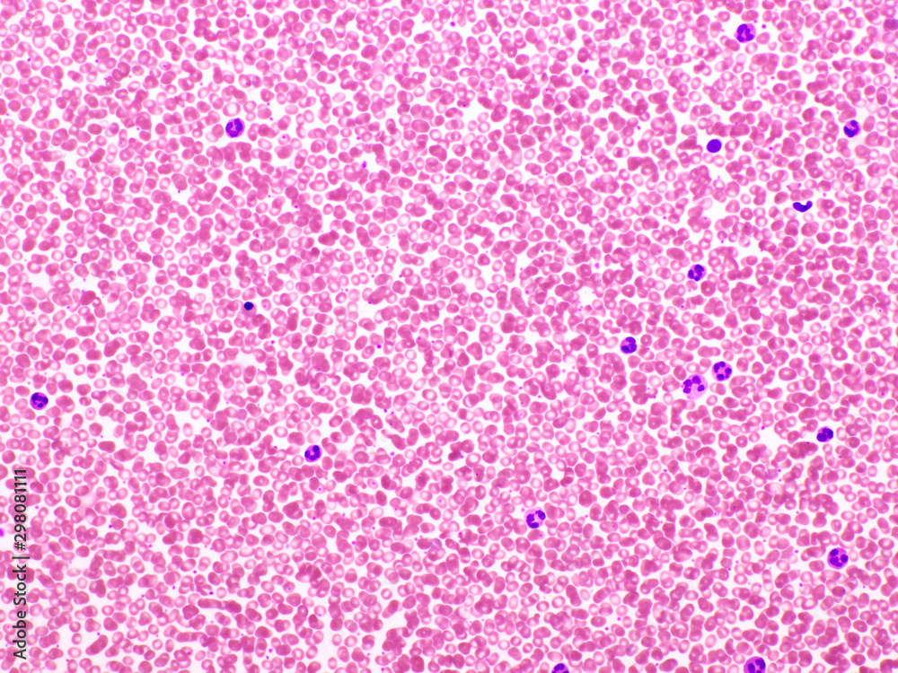 Picture of white blood cell, red blood cell and platelet in blood film ...