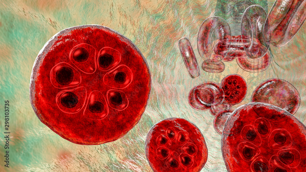 The malaria-infected red blood cell. 3D illustration showing parasite ...