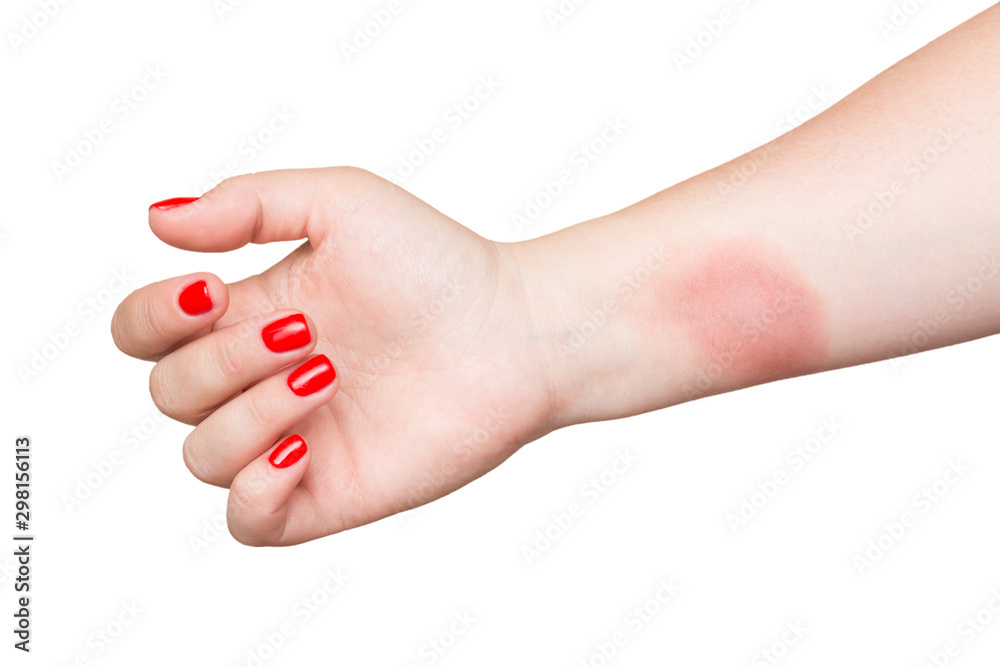 Burn on female hand with red nails isolated on white background. Stock ...