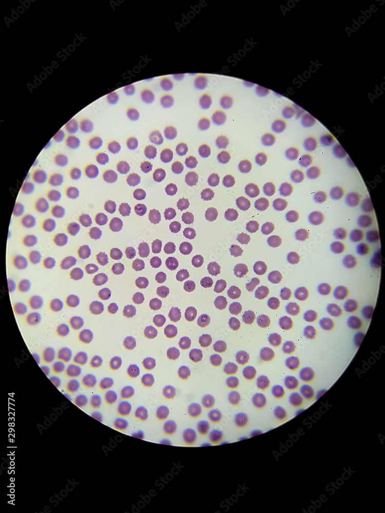 Piroplasmosis or babesiosis dog's infected blood cell under microscope ...