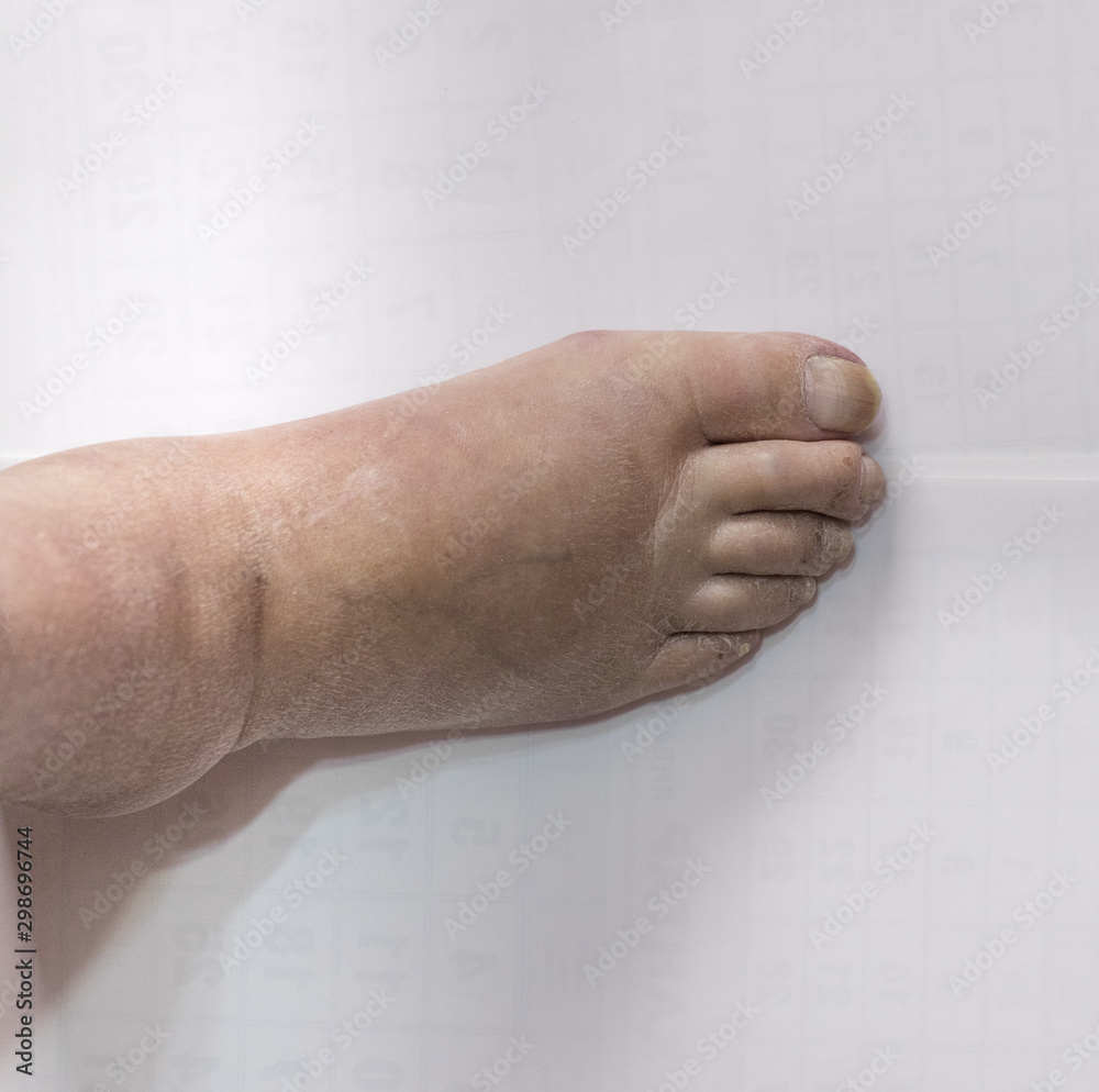 swollen legs with fungal infection isolated on white background Stock ...