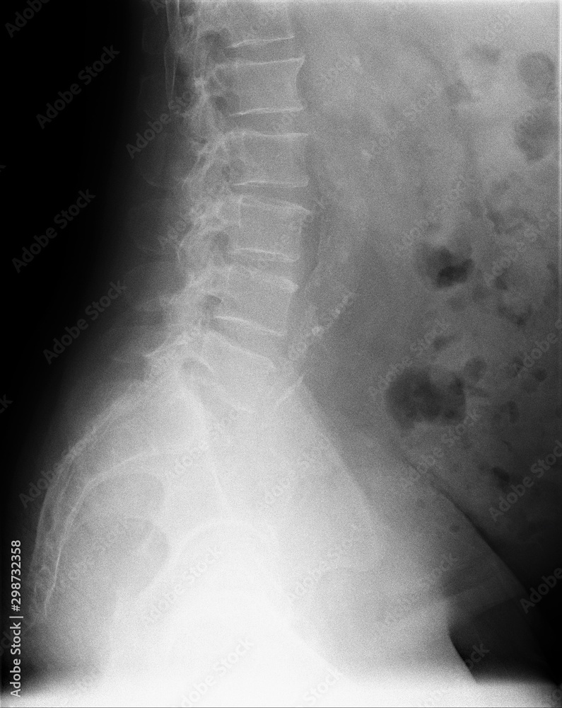 radiograph of lumbar and sacral spine in lateral projection, medical ...