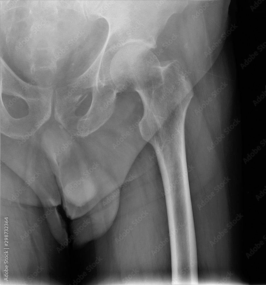 radiograph of the hip joint,medicine,diagnostic,ottopedia Stock Photo ...