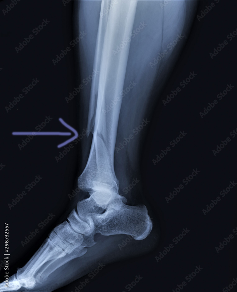 on the radiograph fracture of the fibula, medical diagnosis ...