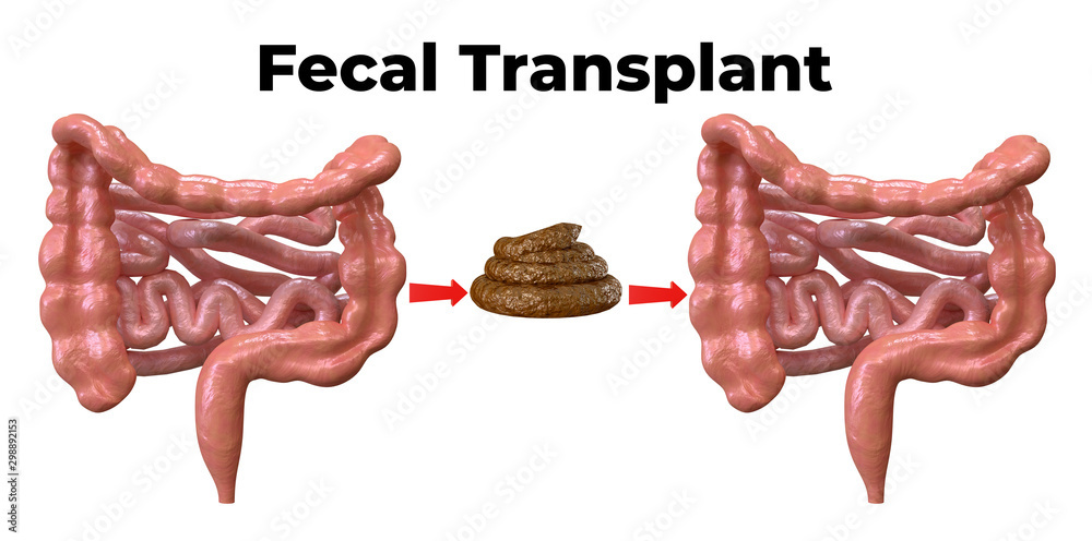 Poster Fecal microbiota transplantation is a procedure in which a donor ...