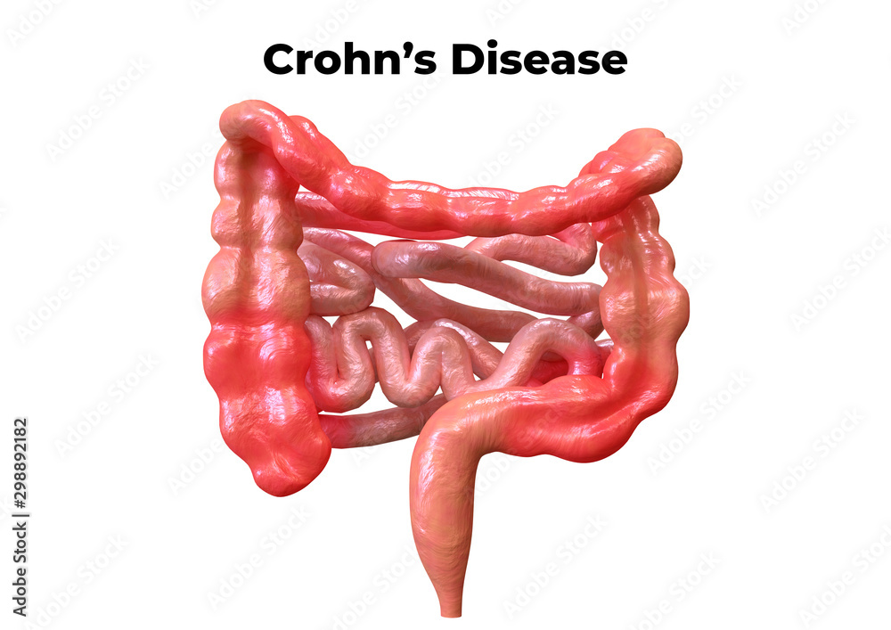 Crohn's disease is a syndrome that affects the digestive system. Its ...