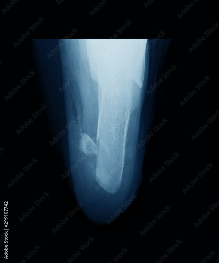 Plakat X-ray image of Axial calcaneus (heel) showing achilles tendon ...
