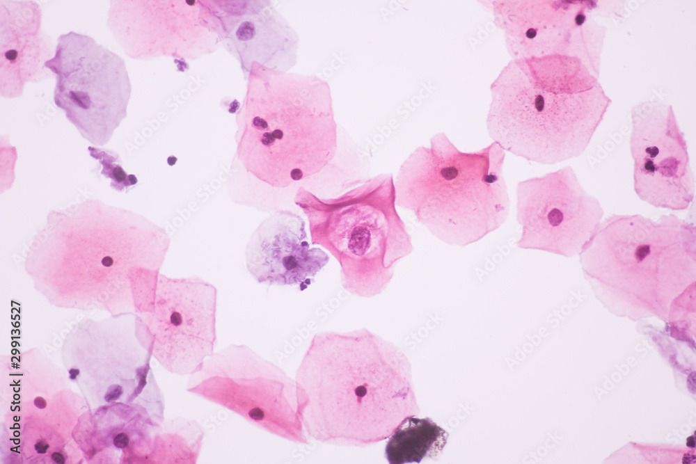 View in microscopic of abnormal human cervix cells.Koilocyte cell ...